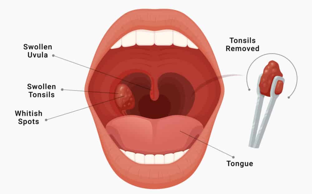 Tonsillectomy Century ENT Tonsillectomy Century ENT